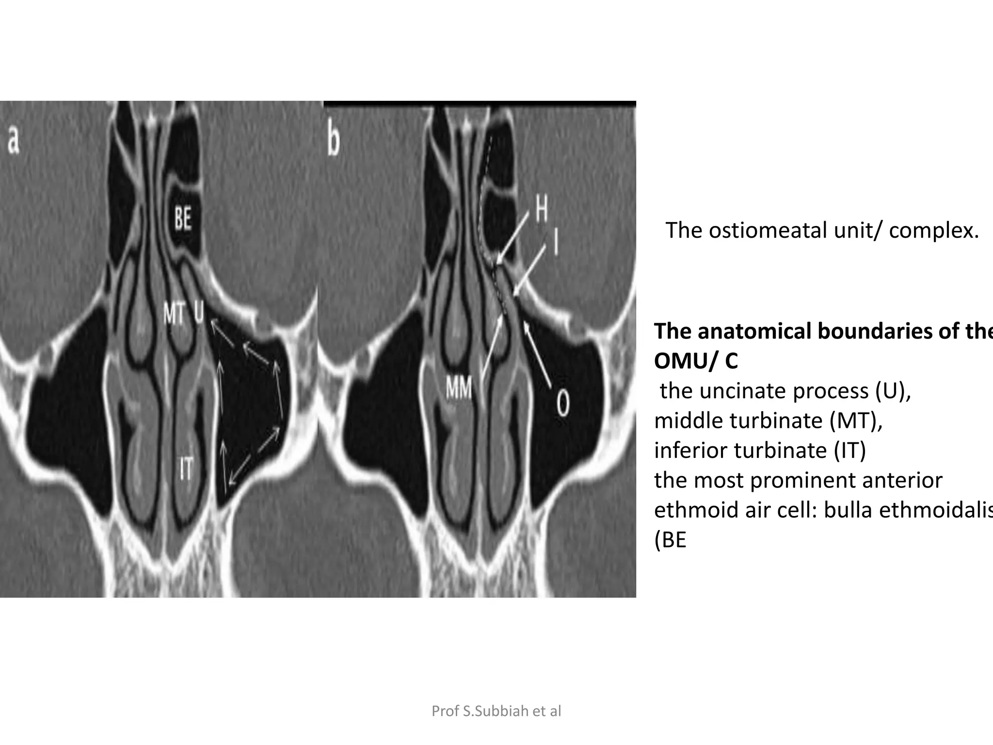Carcinoma Maxillary sinus | PPTX