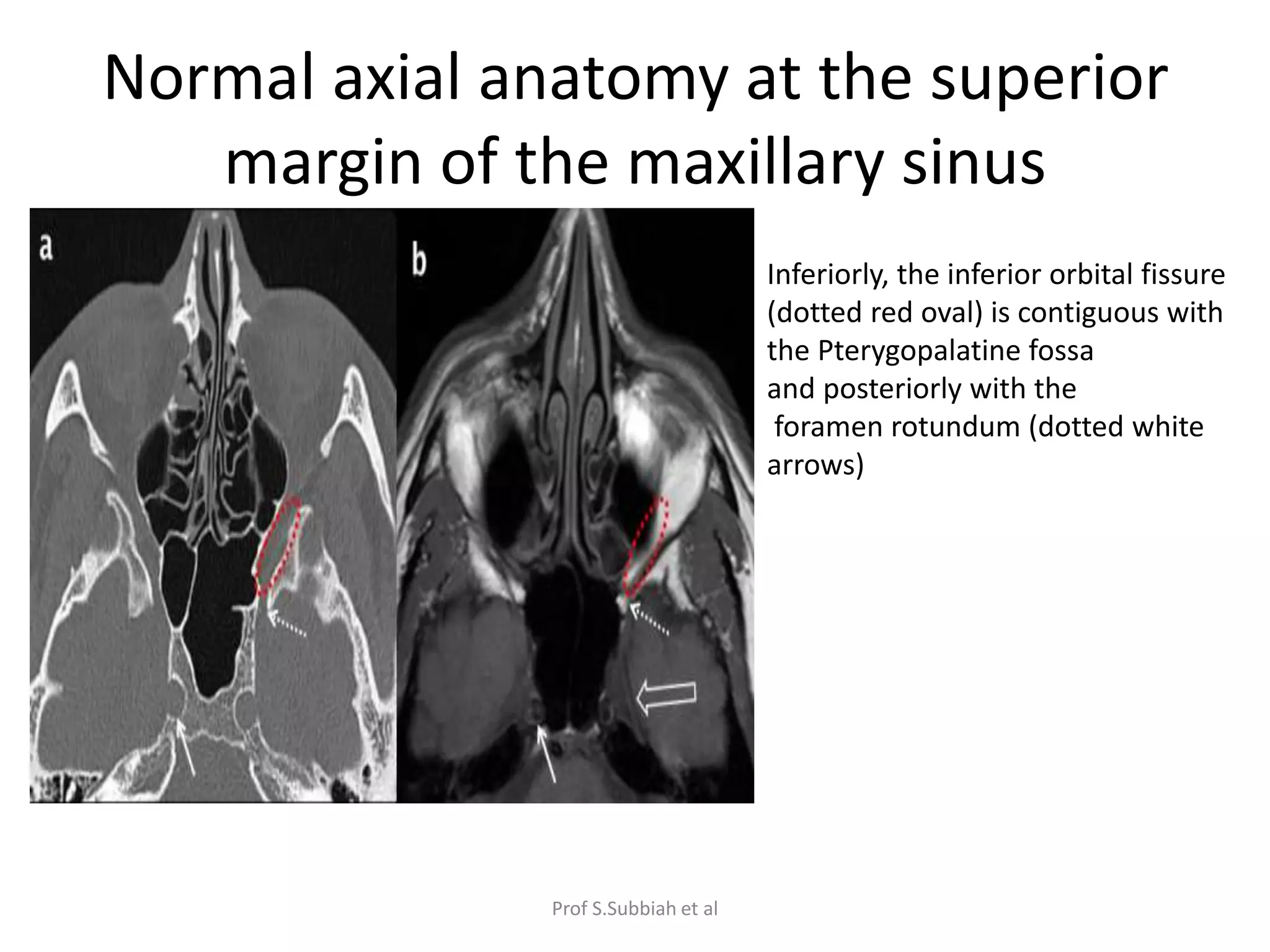 Carcinoma Maxillary sinus | PPTX