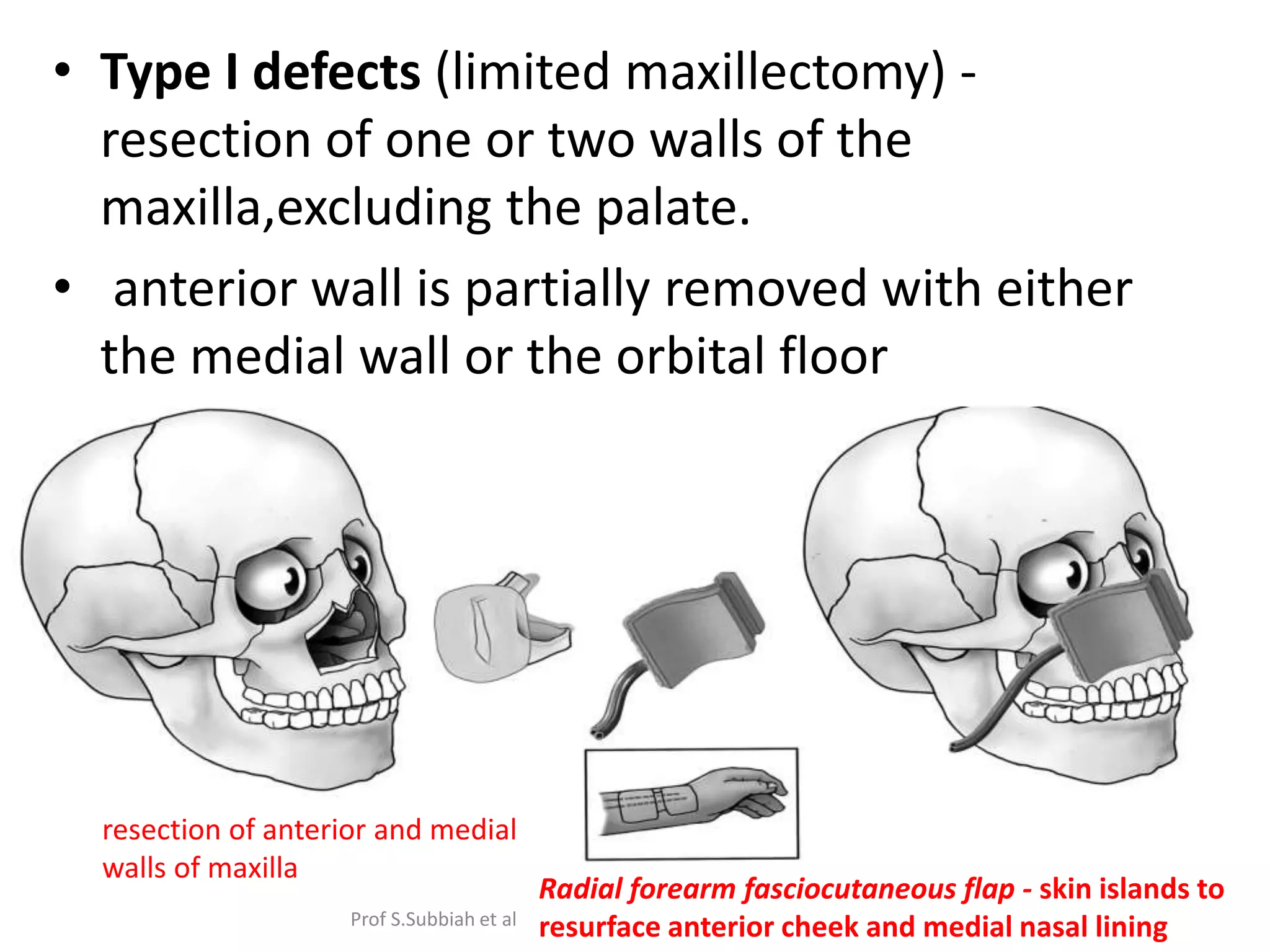 Carcinoma Maxillary sinus | PPTX