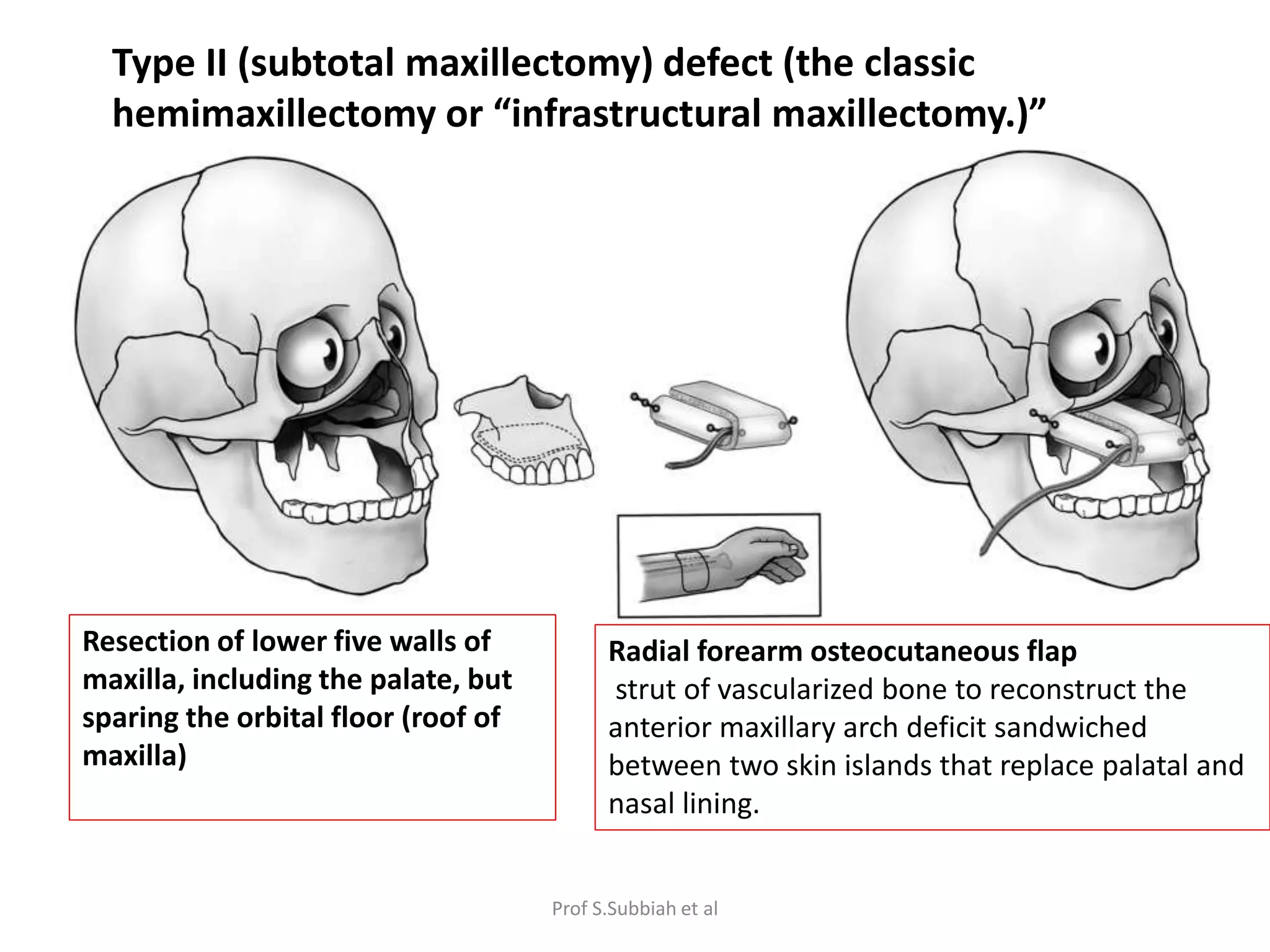Carcinoma Maxillary sinus | PPTX