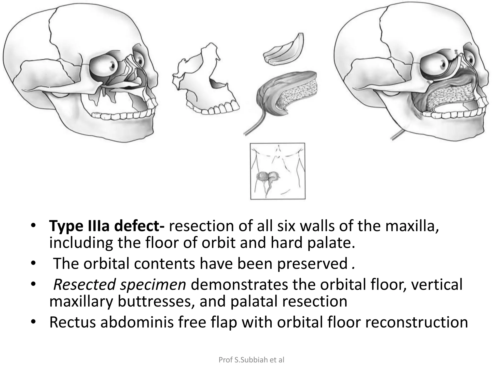 Carcinoma Maxillary sinus | PPTX