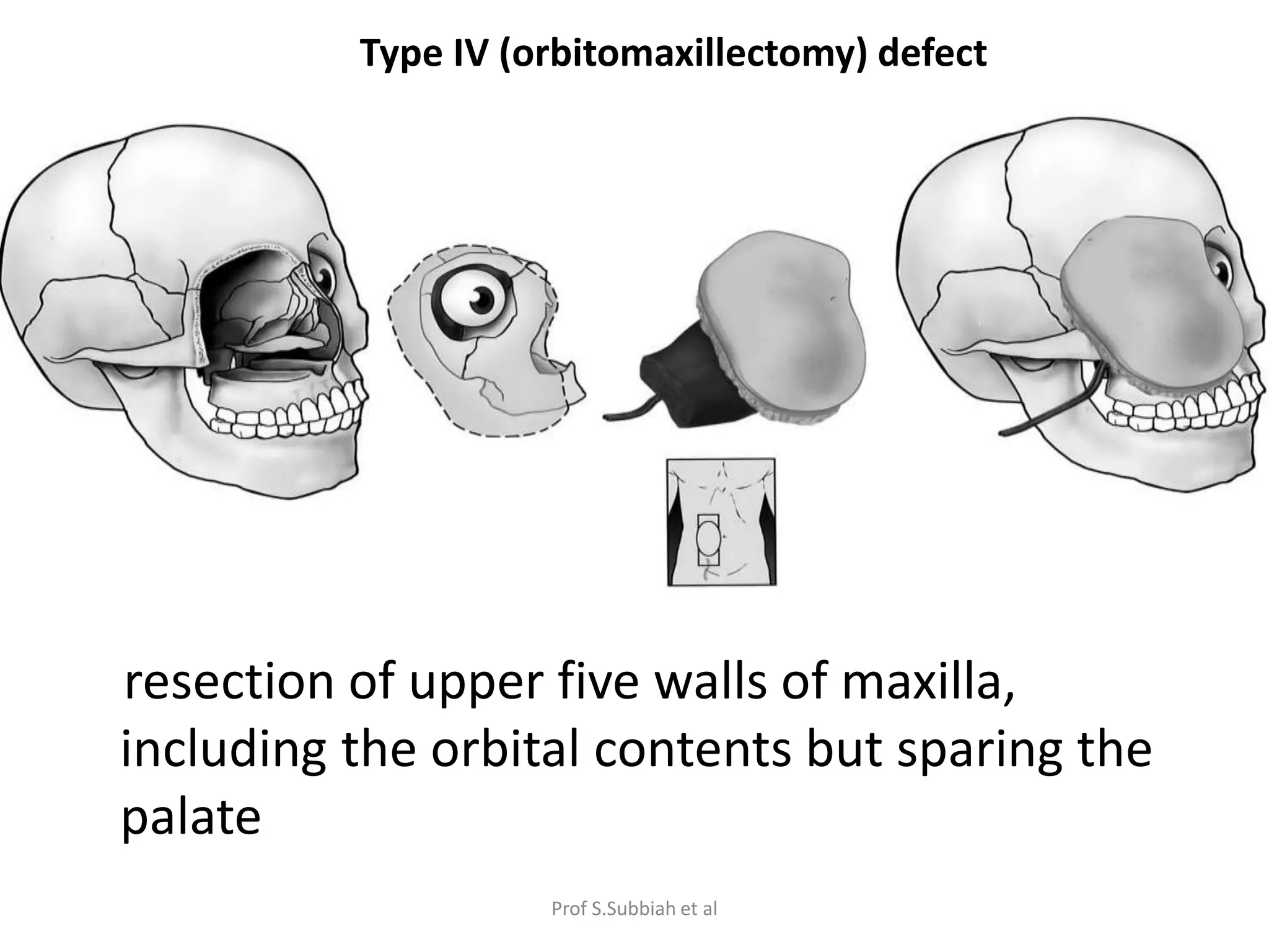 Carcinoma Maxillary sinus | PPTX