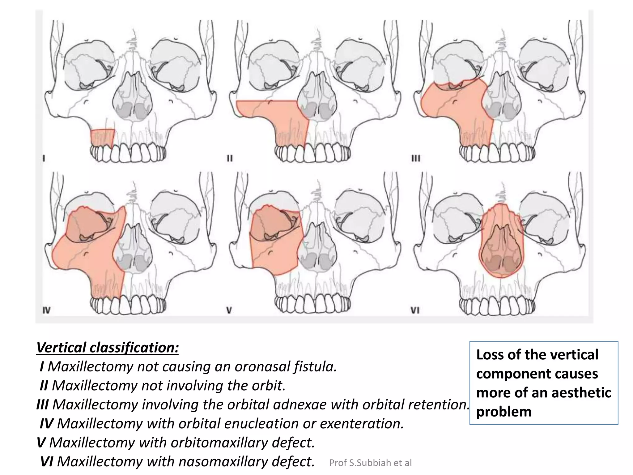 Carcinoma Maxillary sinus | PPTX