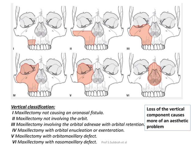 Carcinoma Maxillary sinus | PPTX