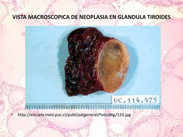 Carcinoma medular de tiroides
