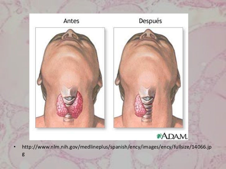 Carcinoma medular de tiroides