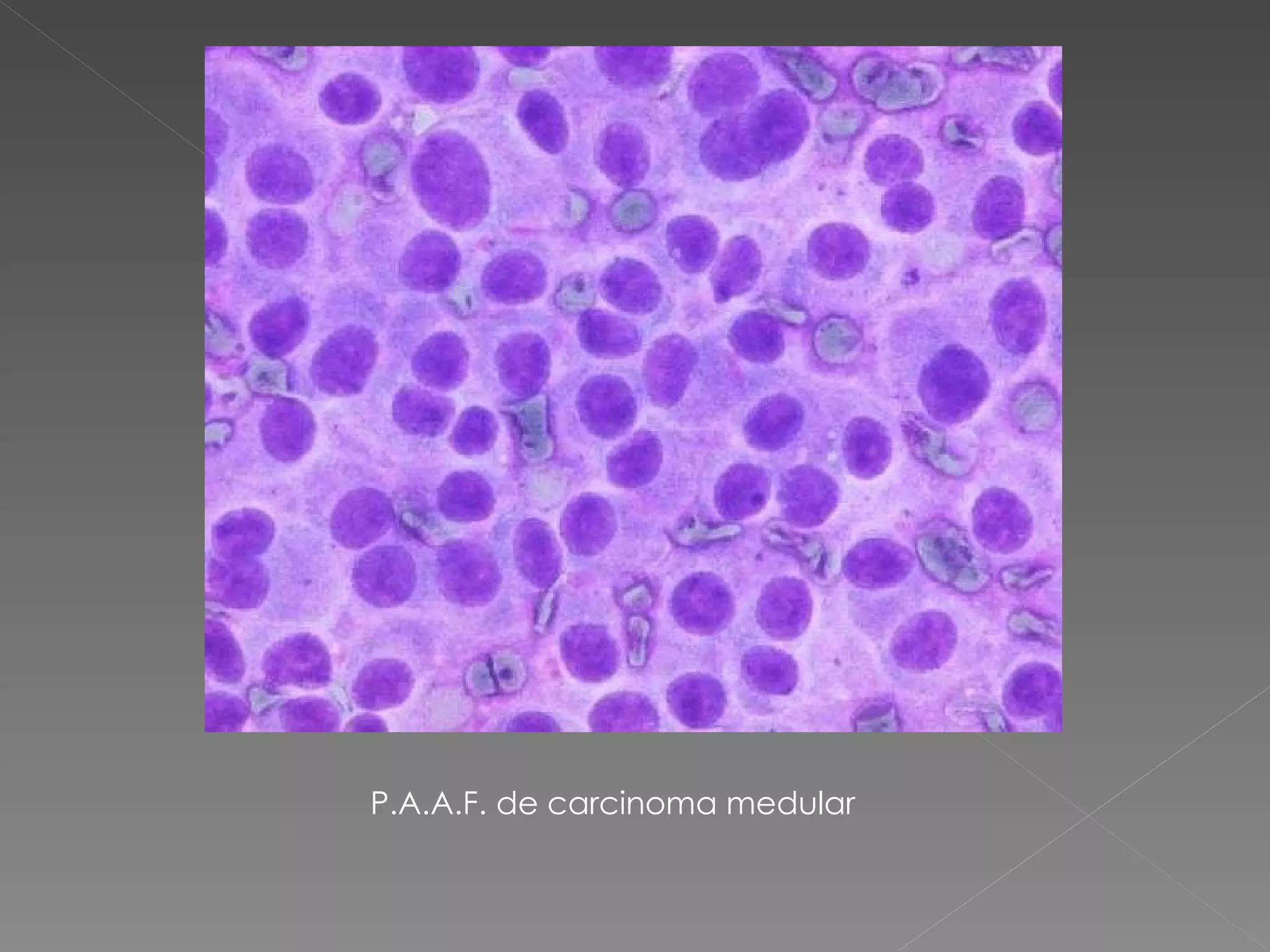 Carcinoma medular de tiroides sully rodriguez castro | PPT | Thyroid ...