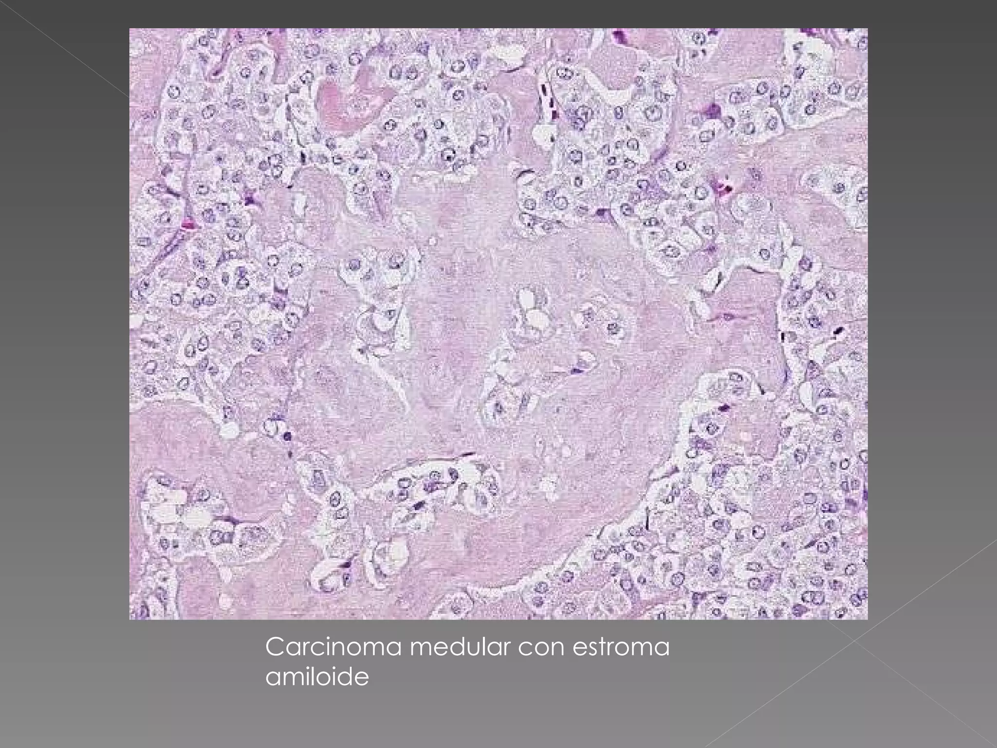 Carcinoma medular de tiroides sully rodriguez castro | PPT | Thyroid ...