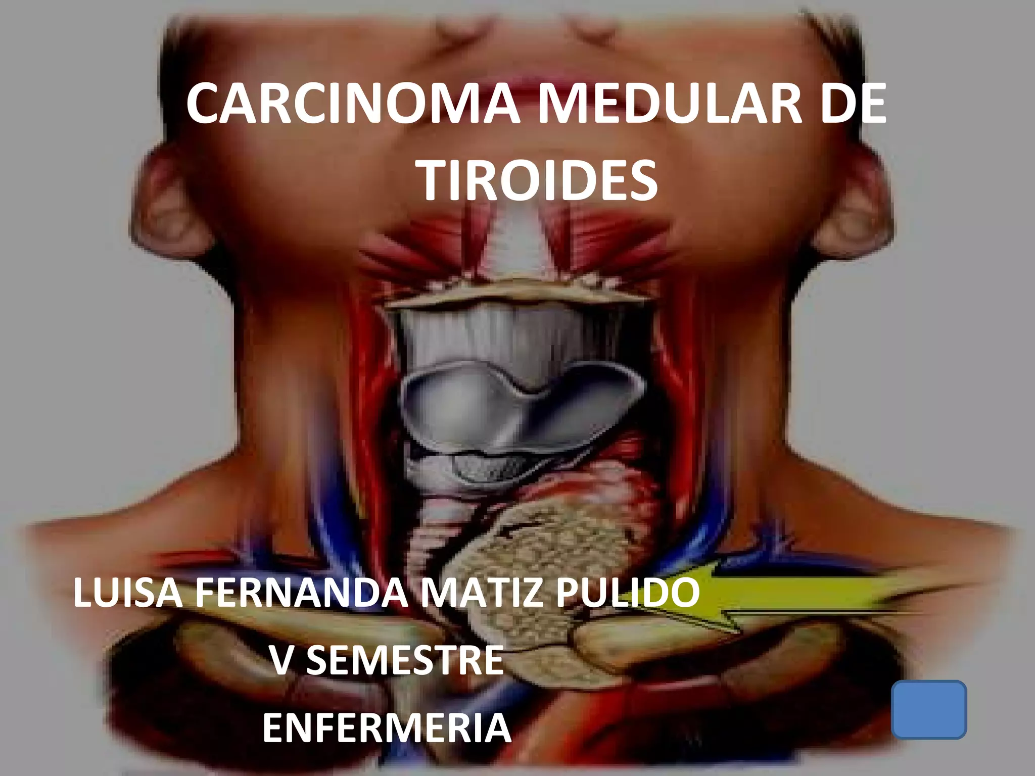 Carcinoma medular de tiroides presentacion | PPT