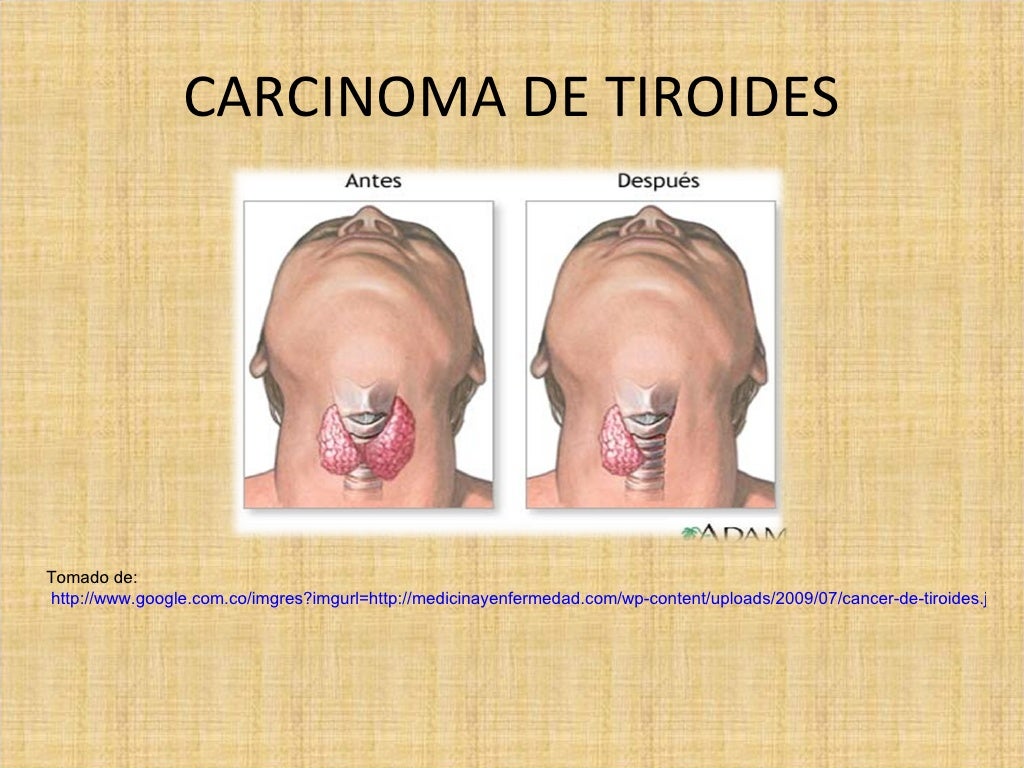 Carcinoma medular de tiroides presentacion