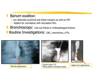 Carcinoma oesophagus | PPT