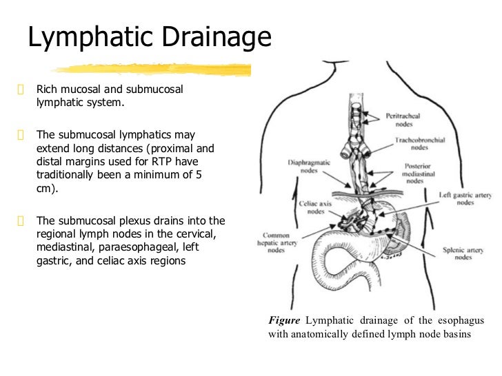 Esophageal Cancer Lymph Nodes Esophageal Cancer Lymph Nodes