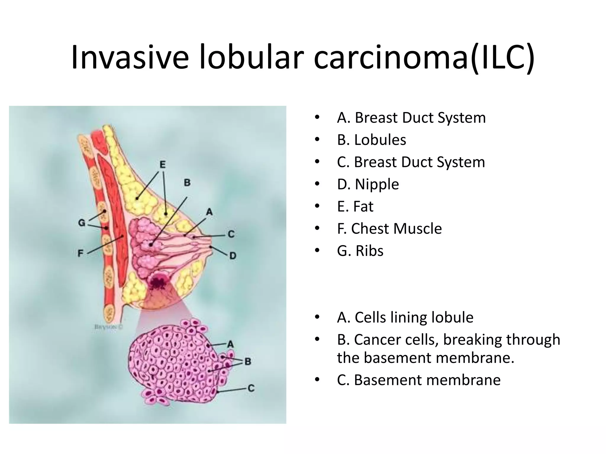 Carcinoma of breast | PPTX