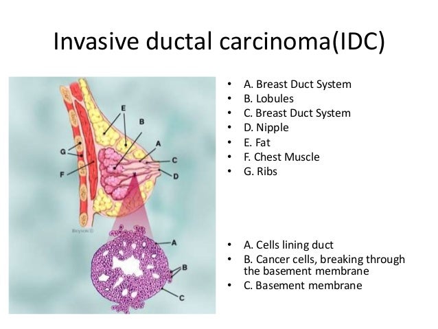 Qiao39s Pathology Invasive Ductal Carcinoma Of The Breast