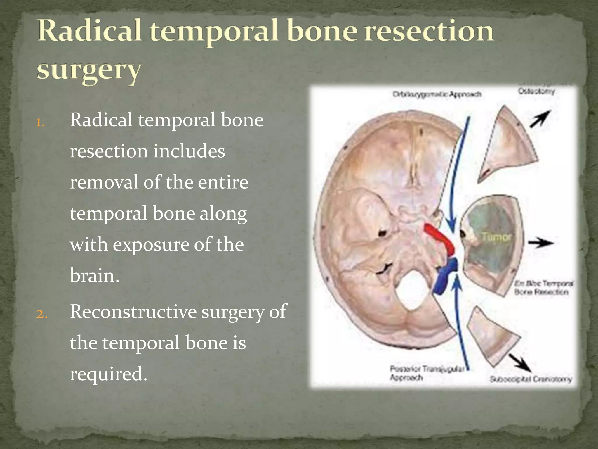 carcinoma of Ear.pptx