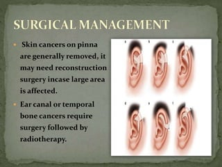 carcinoma of Ear.pptx
