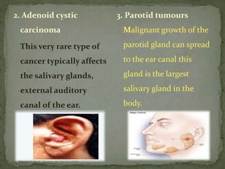 carcinoma of Ear.pptx