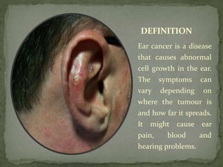 carcinoma of Ear.pptx