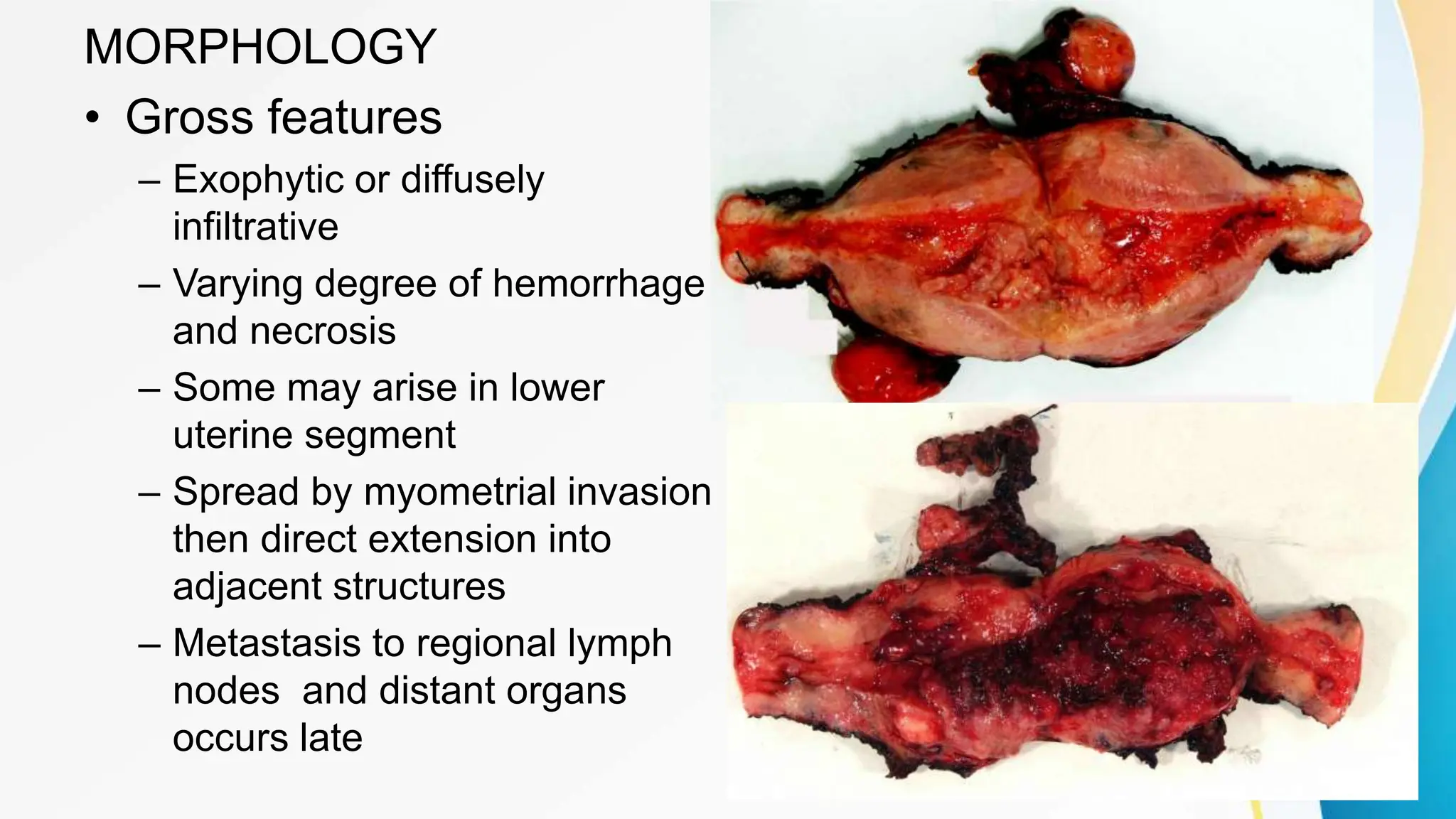 CARCINOMA OF ENDOMETRIUM (endometrioiod and serous carcinoma of uterine ...