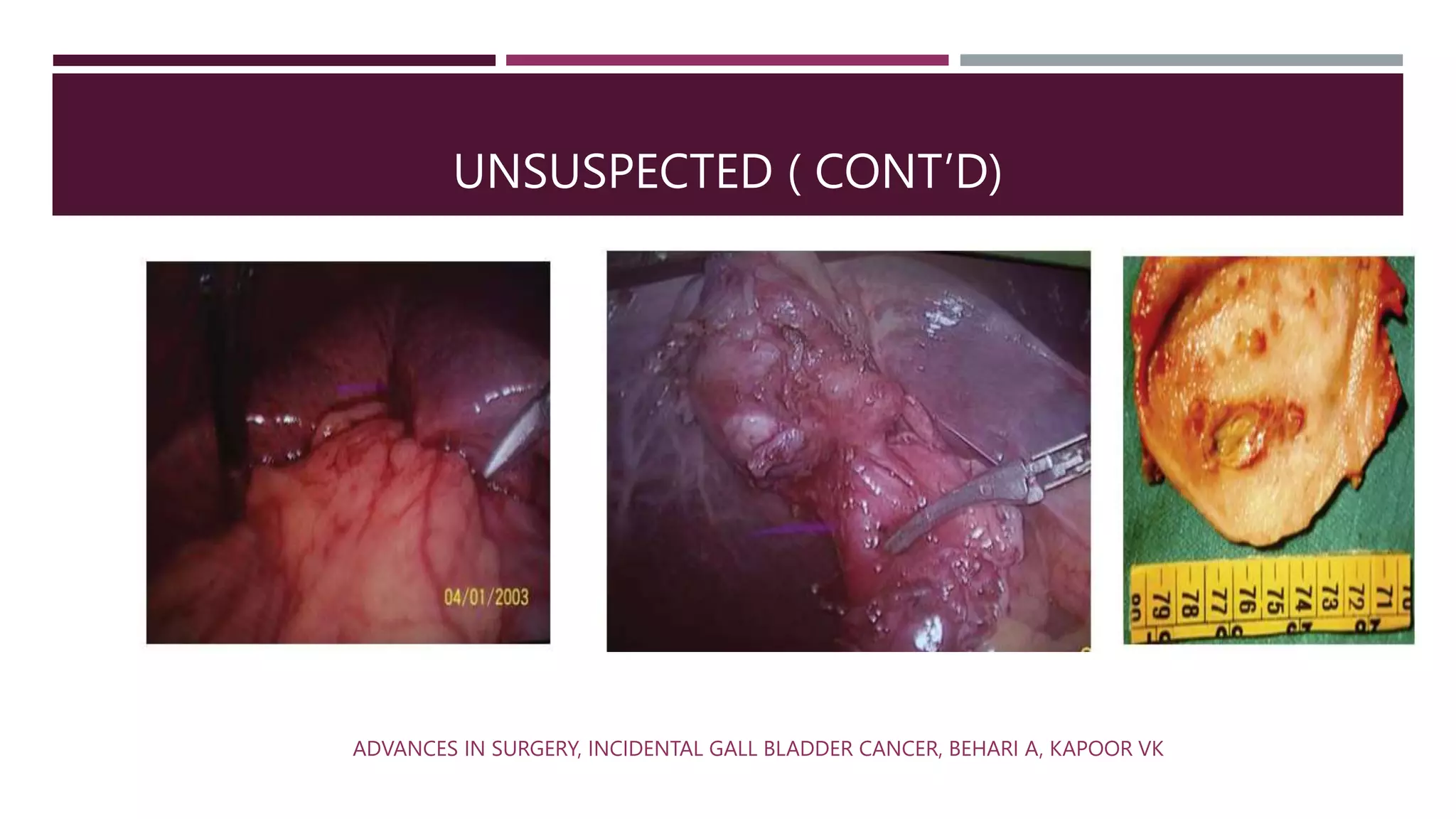 Carcinoma Of gall Bladder.pptx
