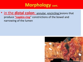 Carcinoma of large intestine, Colorectal Carcinoma (Adenocarcinoma) | PPT