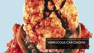 Carcinoma Penis. practical ppt 1234.pptx