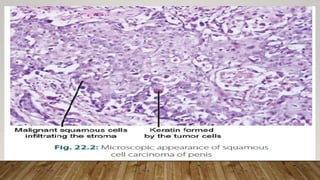 Carcinoma Penis. practical ppt 1234.pptx