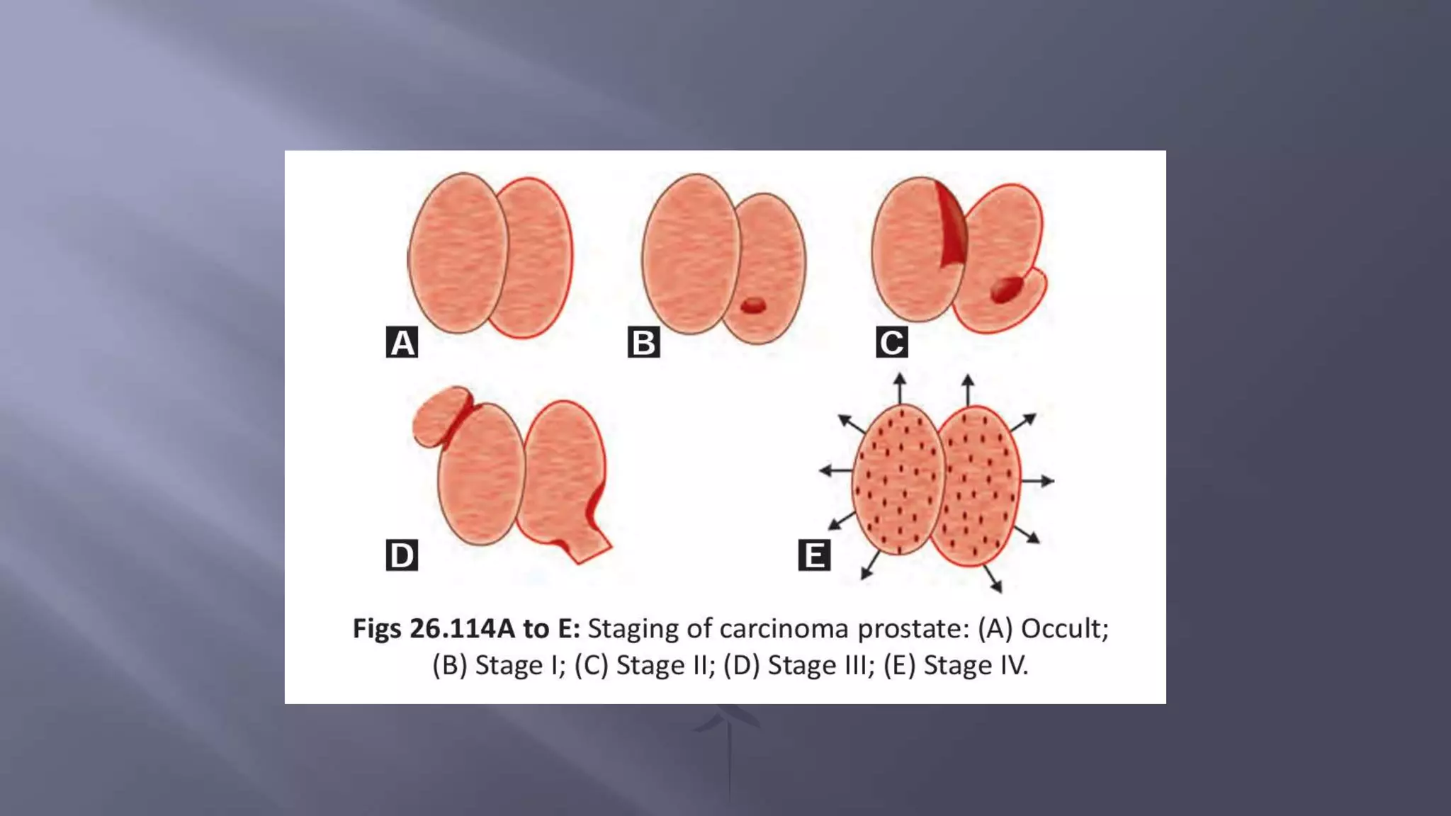 carcinoma prostate - subhash.pptx