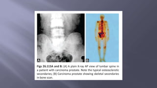 carcinoma prostate - subhash.pptx