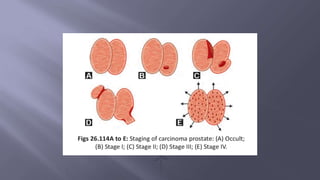 carcinoma prostate - subhash.pptx