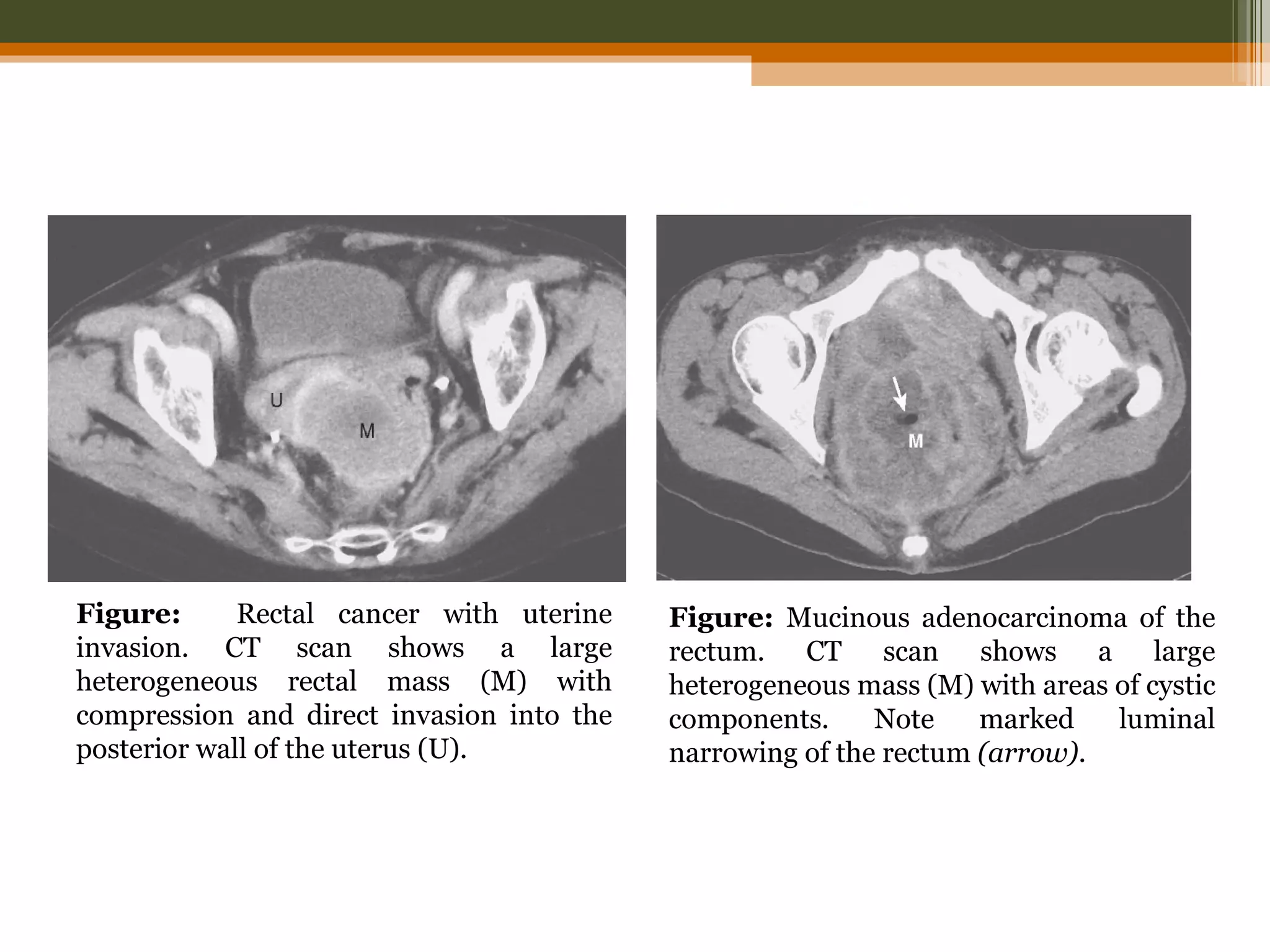 Carcinoma rectum (Rectal Cancer) | PPT