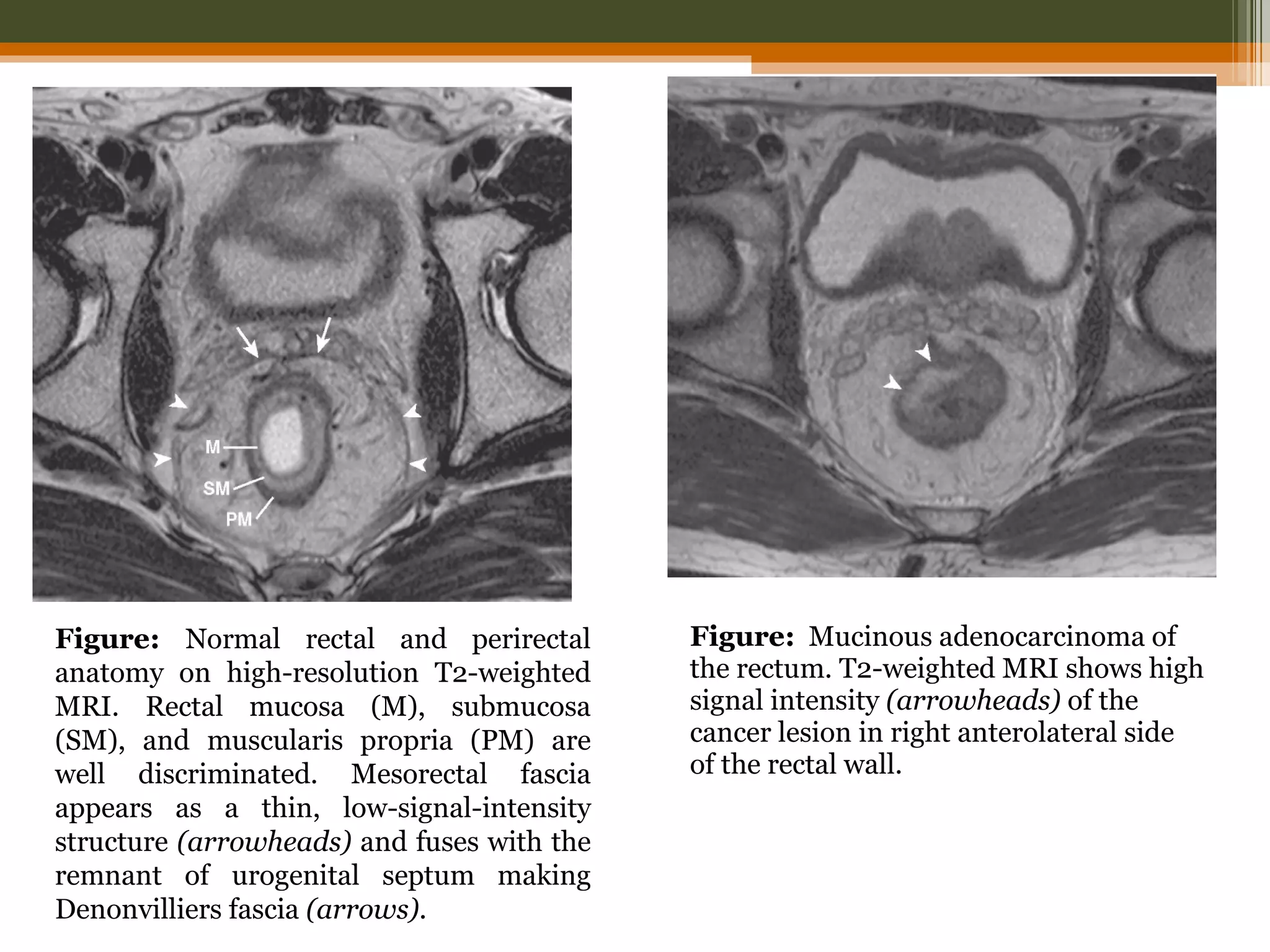 Carcinoma rectum (Rectal Cancer) | PPT