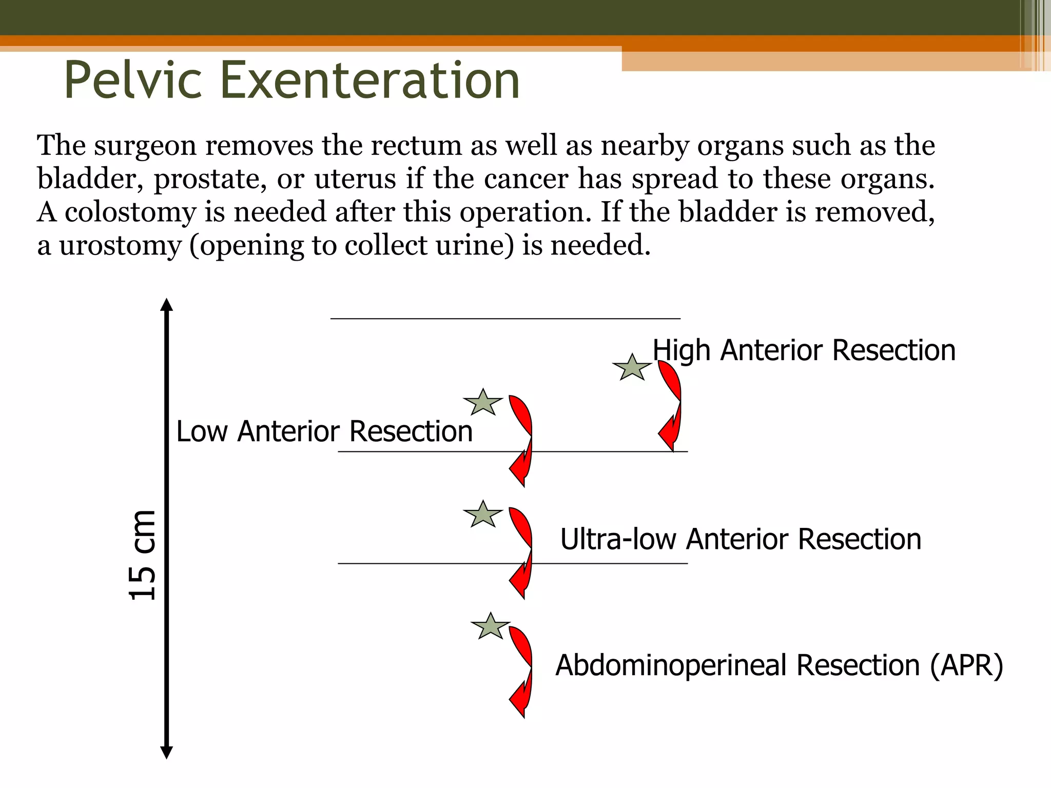 Carcinoma rectum (Rectal Cancer) | PPT