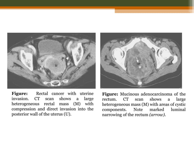Carcinoma rectum (Rectal Cancer) | PPT