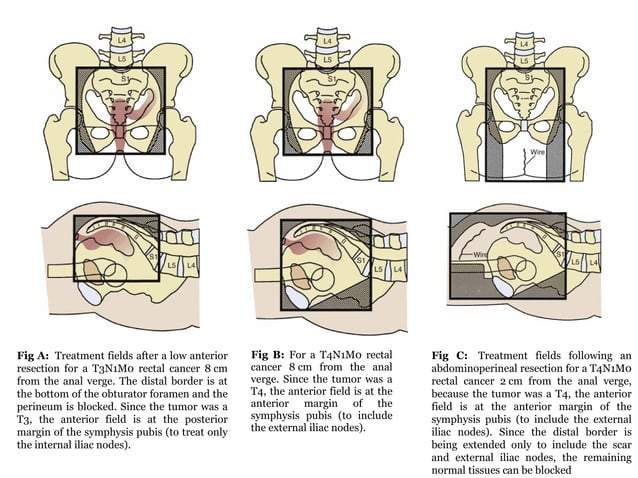 Carcinoma rectum (Rectal Cancer) | PPT