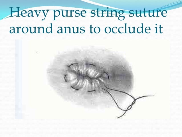 Carcinoma rectum-radiotherapy perspective
