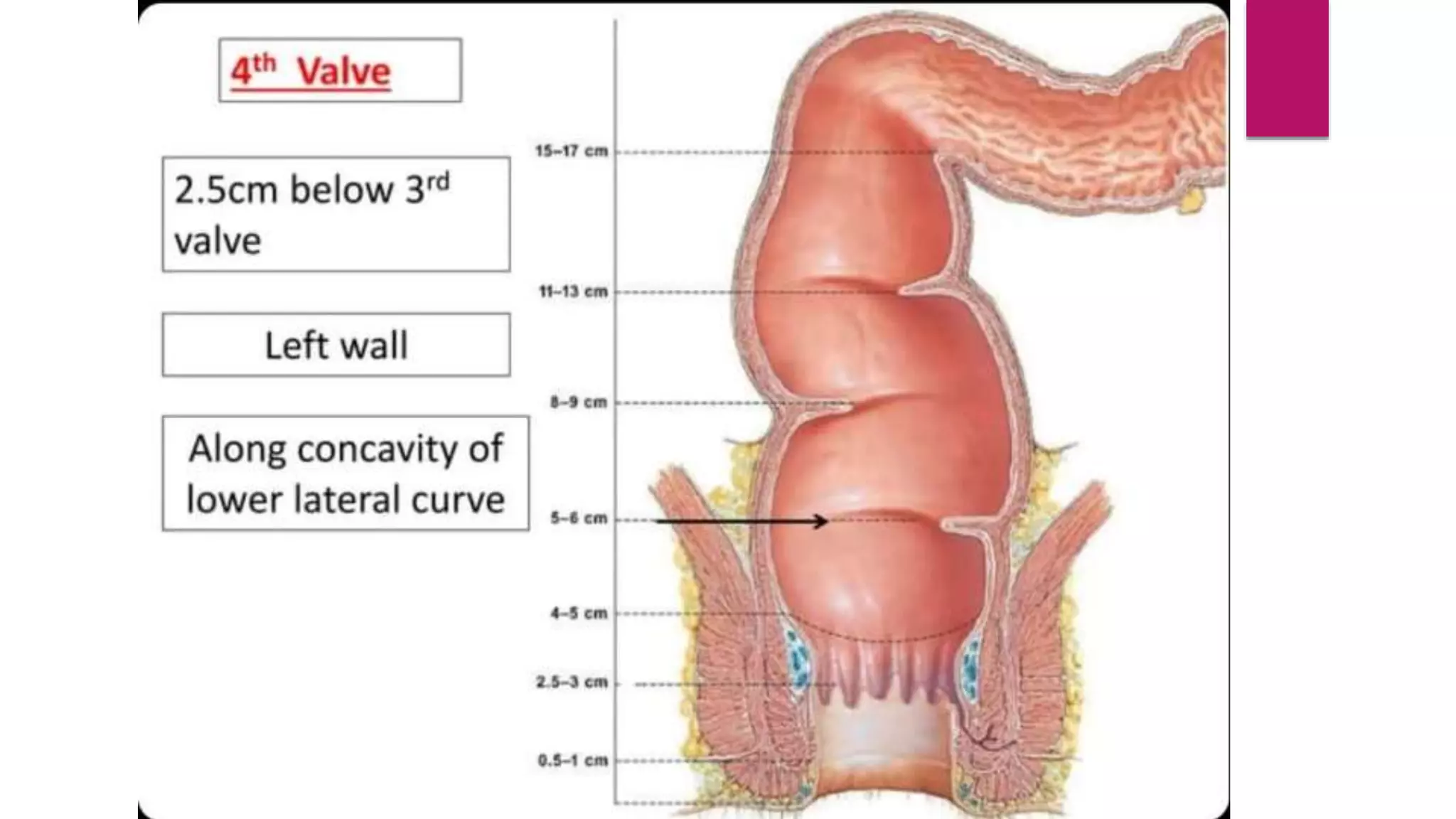 Carcinoma rectum.pptx