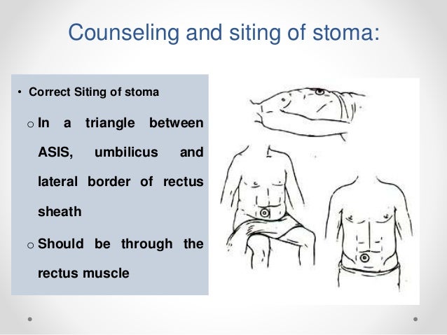 Carcinoma rectum & colon part 2