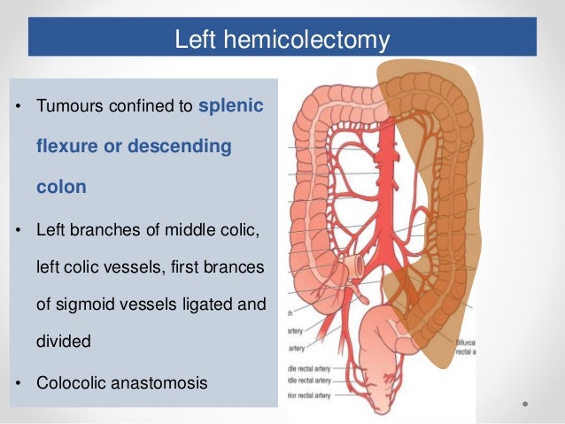 Carcinoma rectum & colon part 2