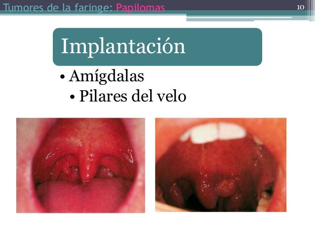 Cancer De Amigdala Hpv Presentaciones Depto. Cirugía Hospital Del