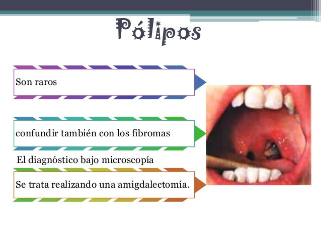 Cancer De Amigdala Estagio 1