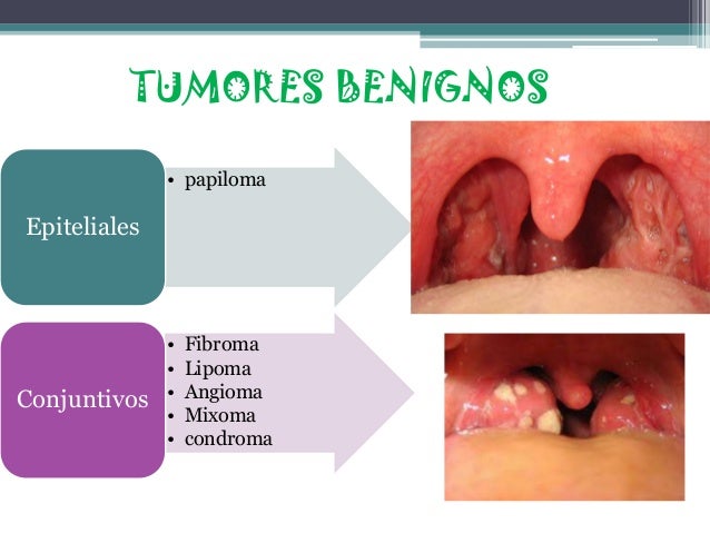 Cancer De Amigdala Hpv Presentaciones Depto. Cirugía Hospital Del