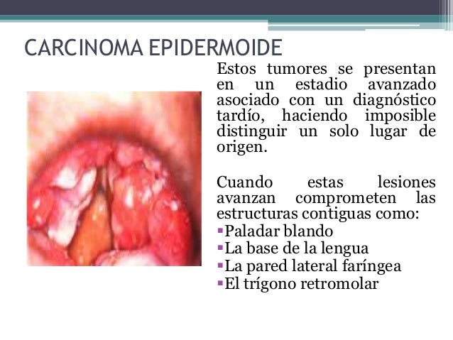 Cancer De Amigdala Hpv Presentaciones Depto. Cirugía Hospital Del