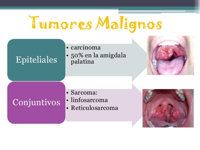 Carcinomas de la amigdala palatina