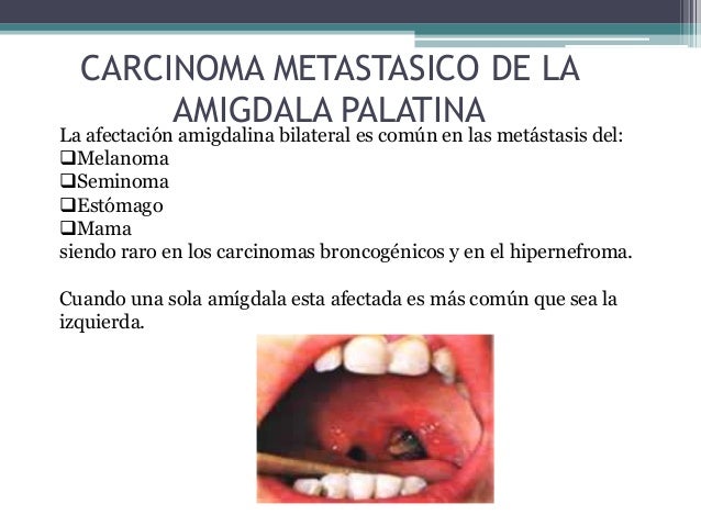 Cancer De Amigdala Estagio 1