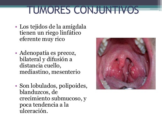 Cancer De Amigdala Hpv Presentaciones Depto. Cirugía Hospital Del