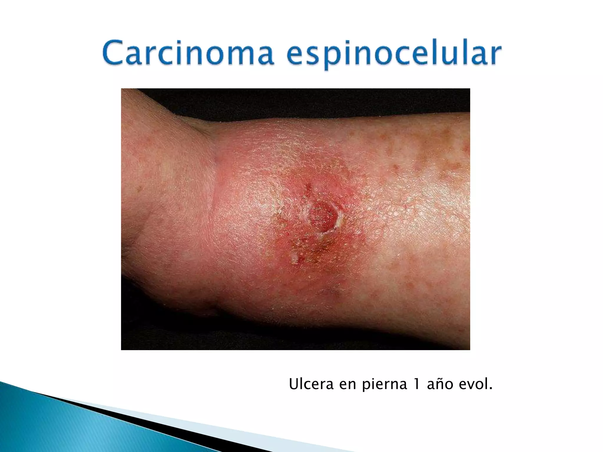 Carcinoma basocelular y espinocelular | PPTX