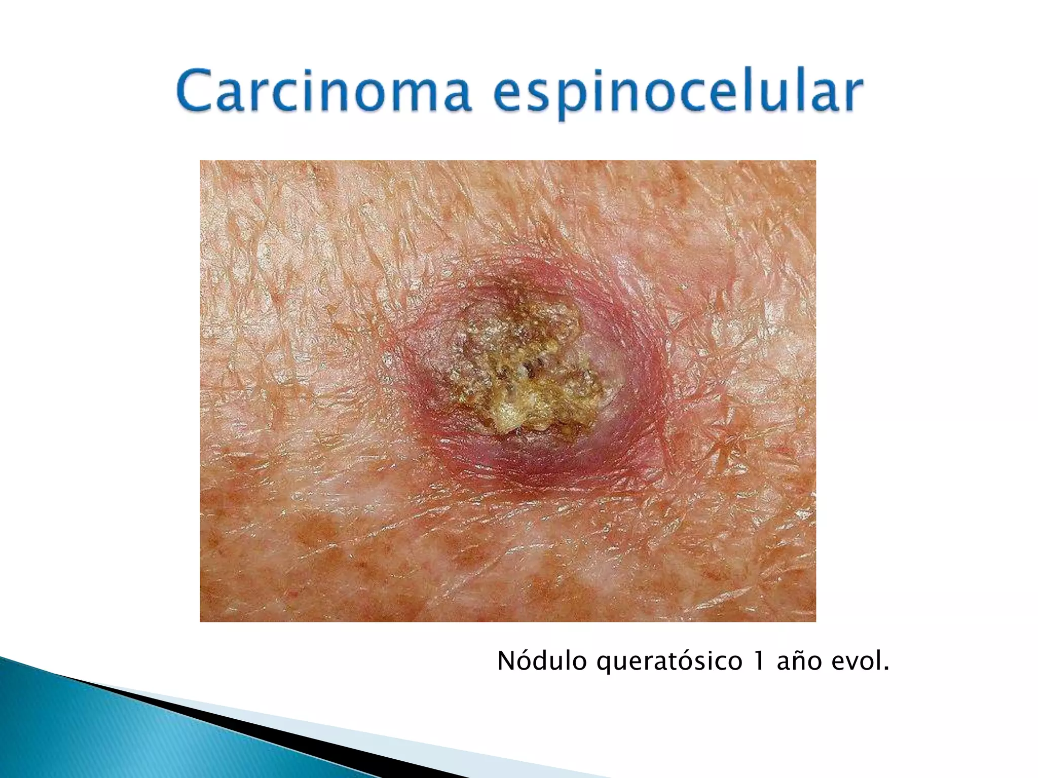 Carcinoma basocelular y espinocelular | PPTX