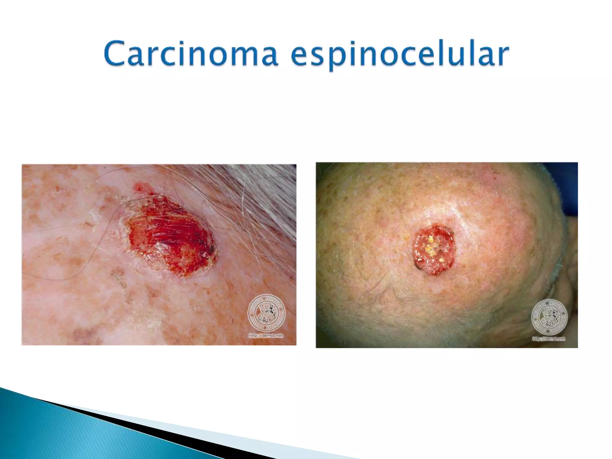 Carcinoma basocelular y espinocelular | PPTX