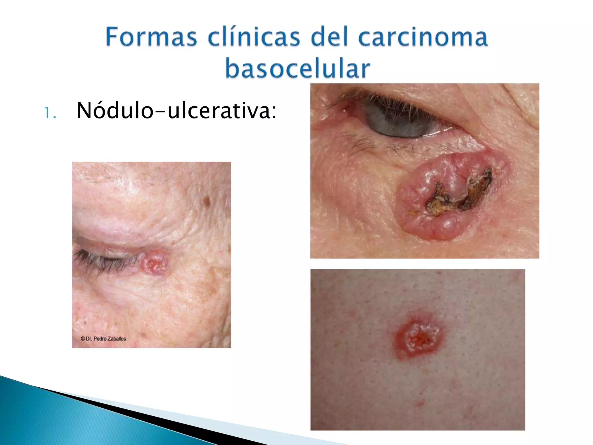 Carcinoma basocelular y espinocelular